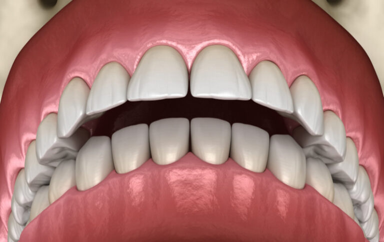 What Is An Overbite, Exactly? | Brownstone Dental, TX