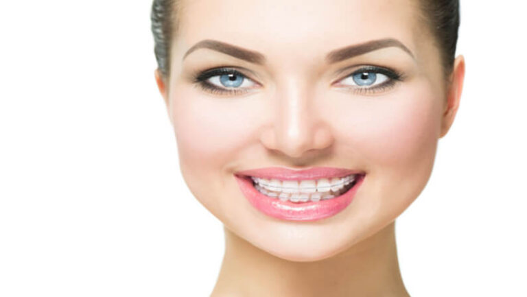 Should You Get Ceramic Braces? Pros And Cons