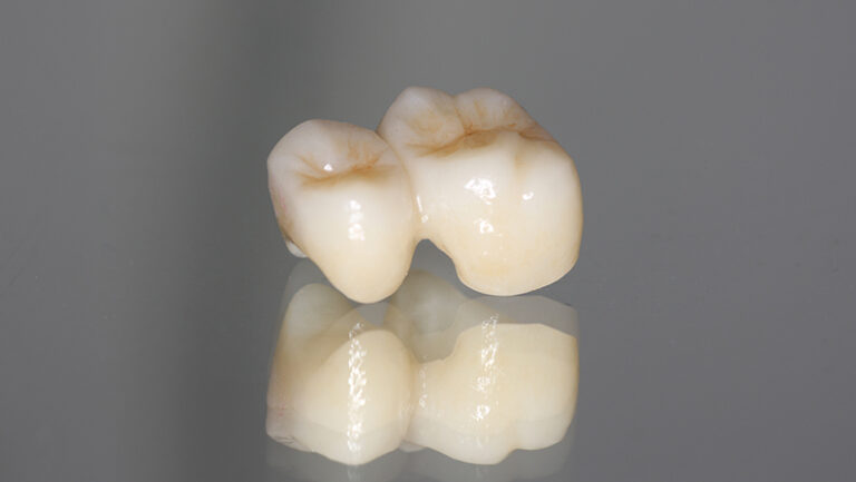 Dental Bridge: Smile Restoration Guide | Houston, Texas