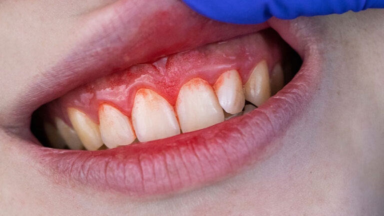 Periodontitis Causes, Symptoms, And Treatment | Houston, TX